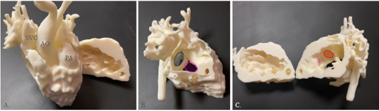 Our Approach to 3D Modeling | ColumbiaDoctors Children's Health