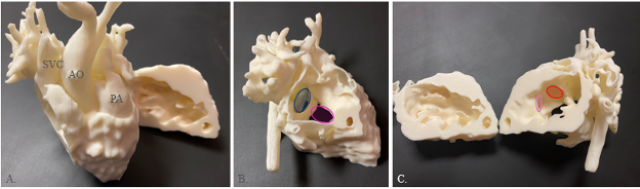 Our Approach to 3D Modeling | ColumbiaDoctors Children's Health