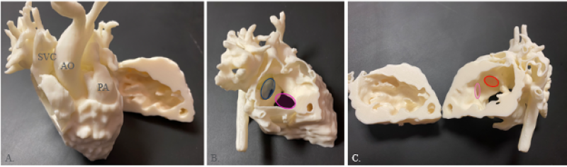 Our Approach to 3D Modeling | ColumbiaDoctors Children's Health