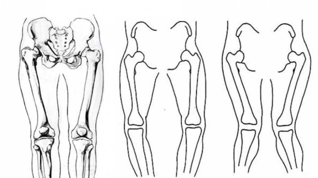 Bowlegs And Knock Knees Pediatric Columbiadoctors New York