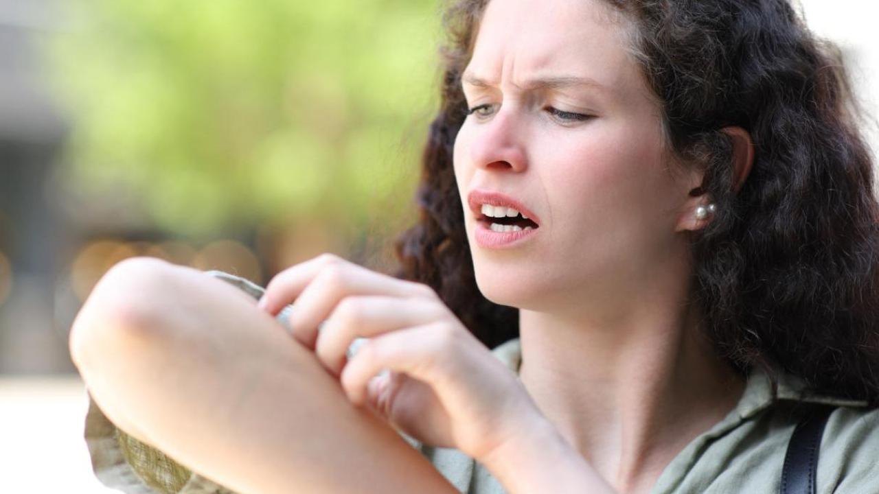 How To Stop Bug Bites From Itching Columbiadoctors