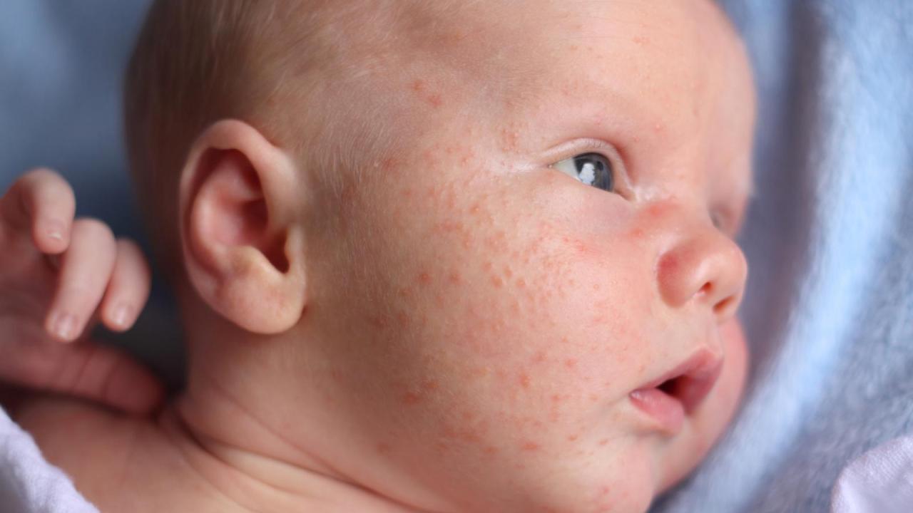 Everything You Need to Know About Baby Acne | ColumbiaDoctors
