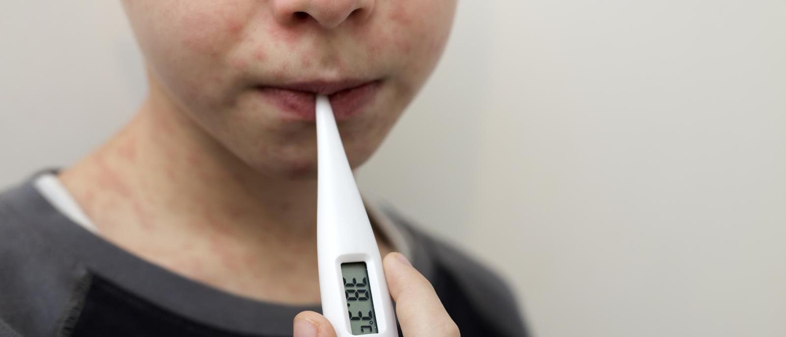 Measles: What You Need to Know | ColumbiaDoctors