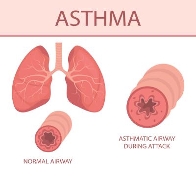 Asthma Information | ColumbiaDoctors