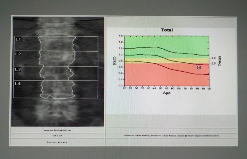 When Should I Get a Bone Density Test? | ColumbiaDoctors