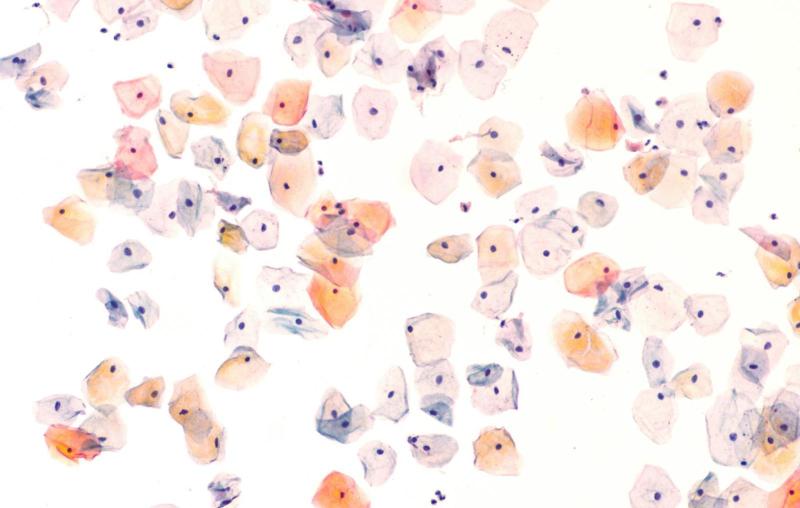 Abnormal Pap Tests Are Common, So What Do They Mean? | ColumbiaDoctors