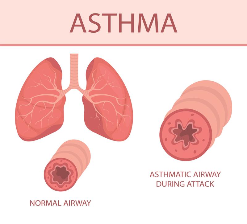 Asthma Information | ColumbiaDoctors
