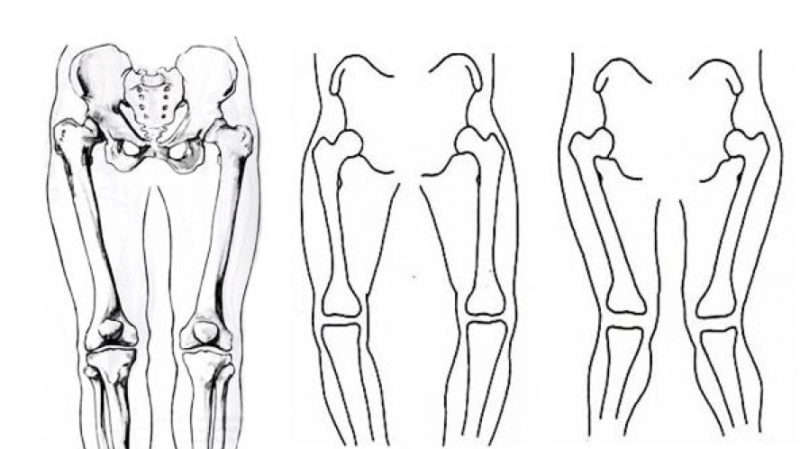 Bowlegs & Knock Knees (Pediatric) | ColumbiaDoctors
